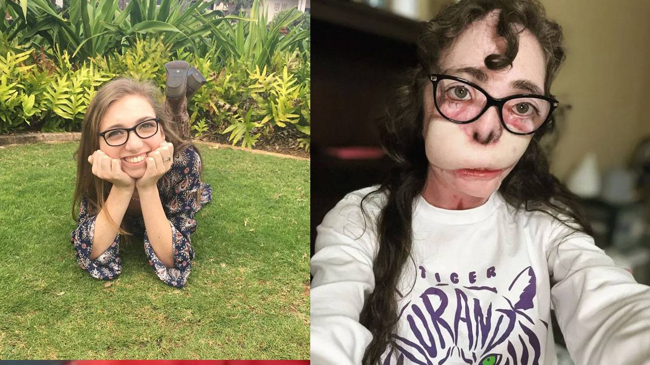 Jacqueline Durand Dog Attack, Here's How She Survived 800 Bites of Dogs ...