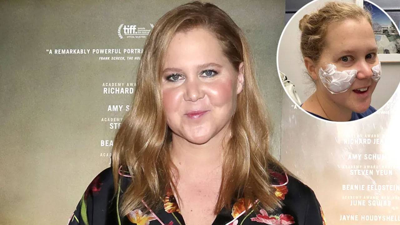 Amy Schumer Cheeks and Fat Face: Amy Schumer Puffy Face, How did Amy ...